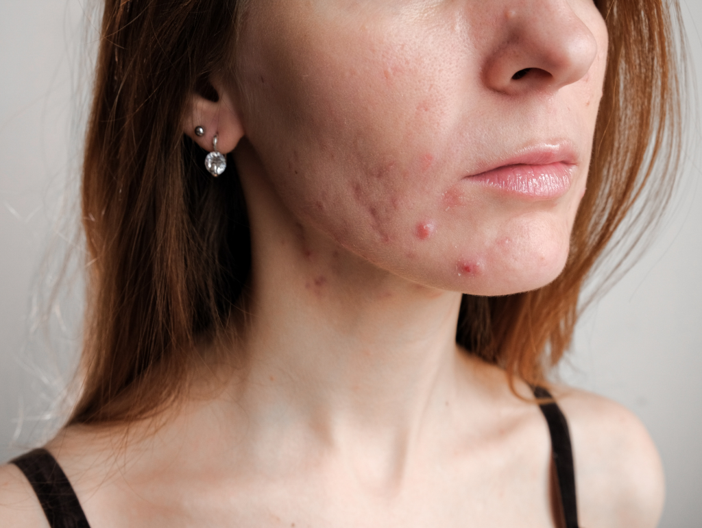 Cystic Acne: The Deep, Painful Truth About Your Skin's Most Aggressive ...